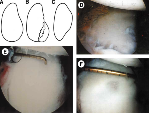 Bone Loss and Shoulder Dislocations